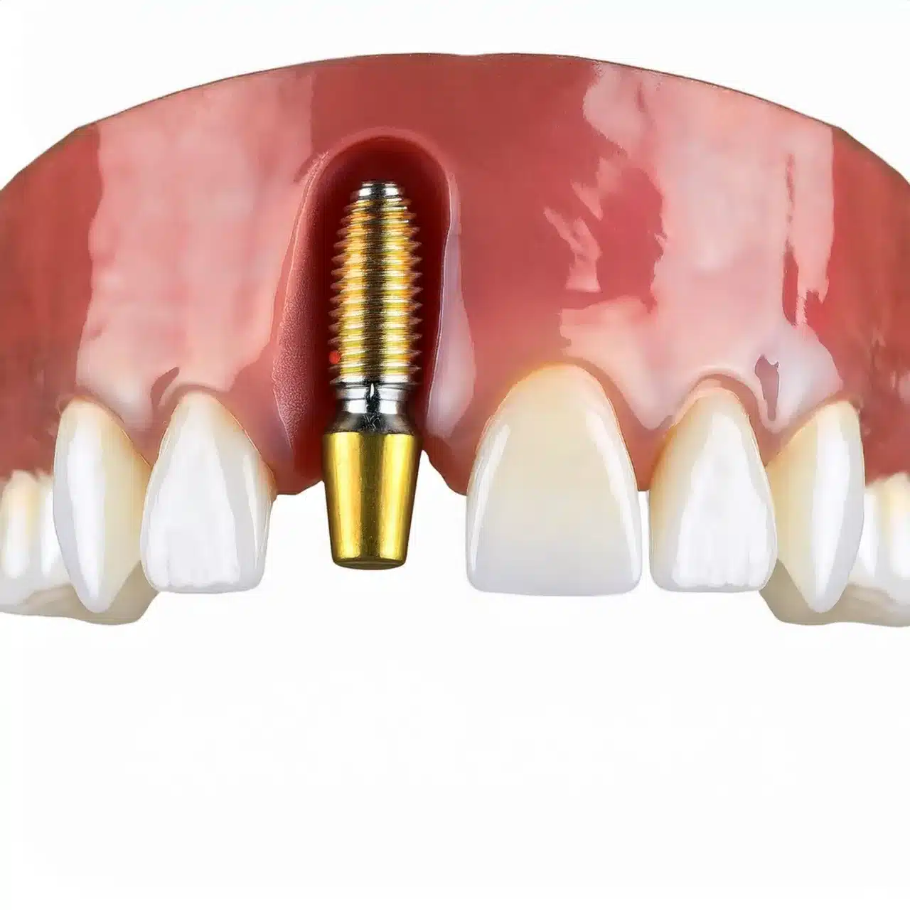 Implante dental unitario