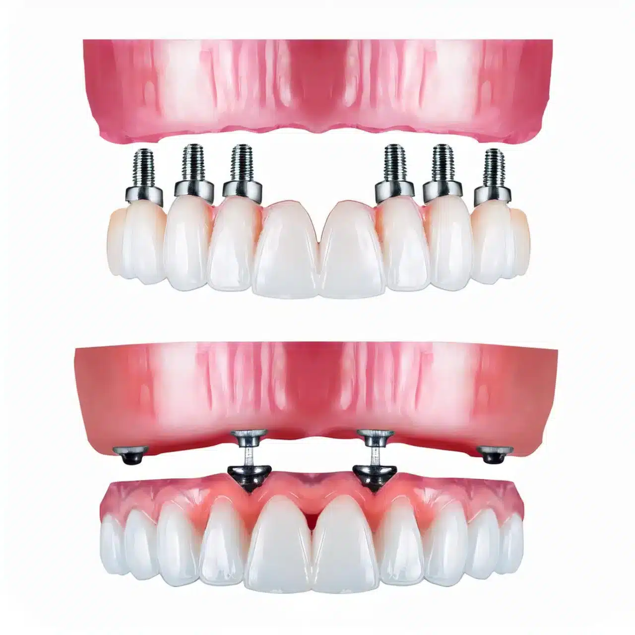 Implantes dentales All-on-4: Arco único frente a boca completa