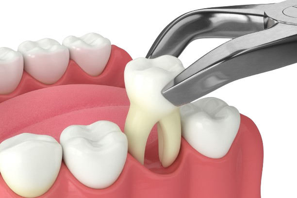 Tooth Extraction in Albania – 2026 Prices, Procedure & All-Inclusive Care
