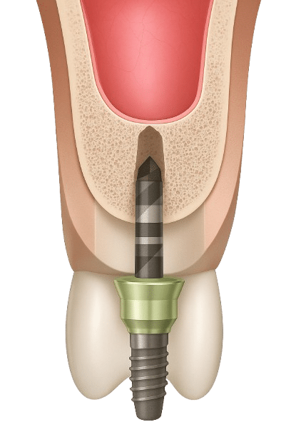 Crestal Sinus Lift